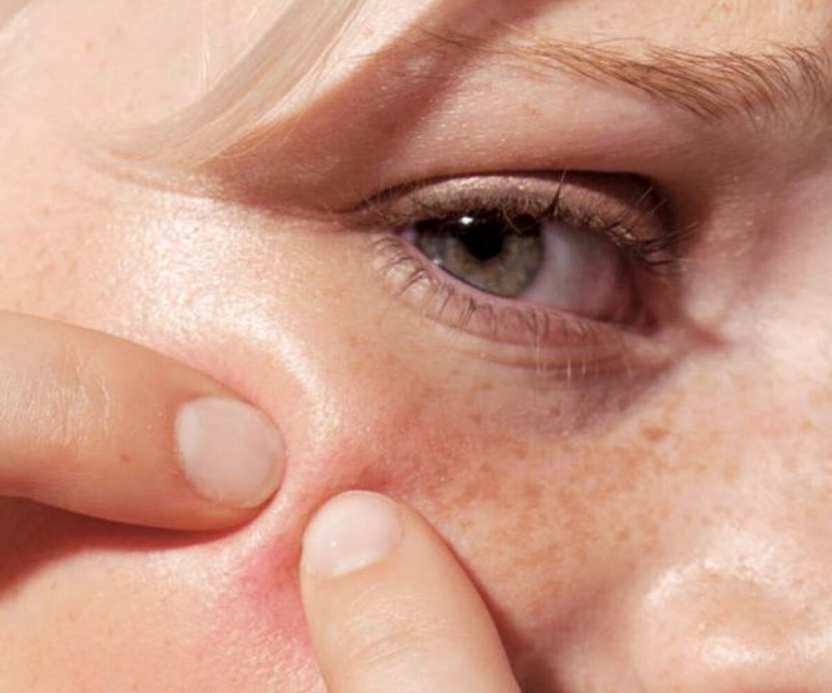 how-to-pop-a-pimple-with-minimal-damage-670152.jpg?v=1750346589